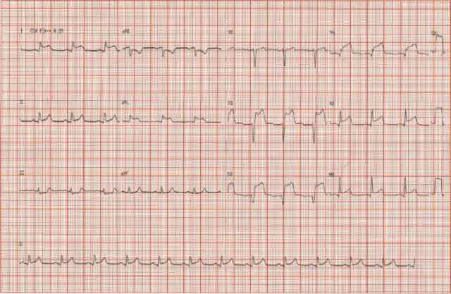 Quais os critérios eletrocardiográficos de infarto com ...