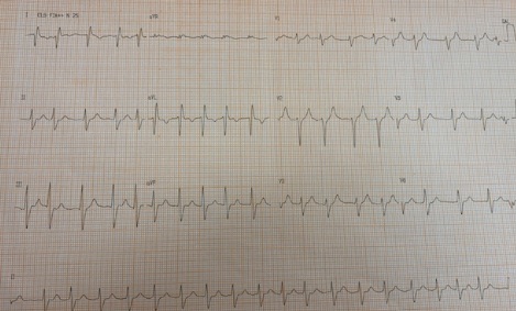 Síndrome de ALCAPA, você conhece? - Portal Afya