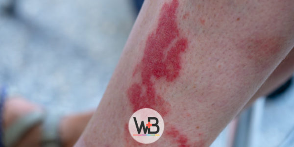 Whitebook: conheça a Doença de Kawasaki e sua abordagem terapêutica ...