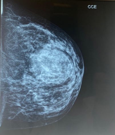 Caso clínico: mulher com nódulo em mama, sem descarga papilar - Portal Afya