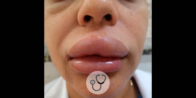 Caso clínico: mulher com edema labial e periorbital - Portal Afya
