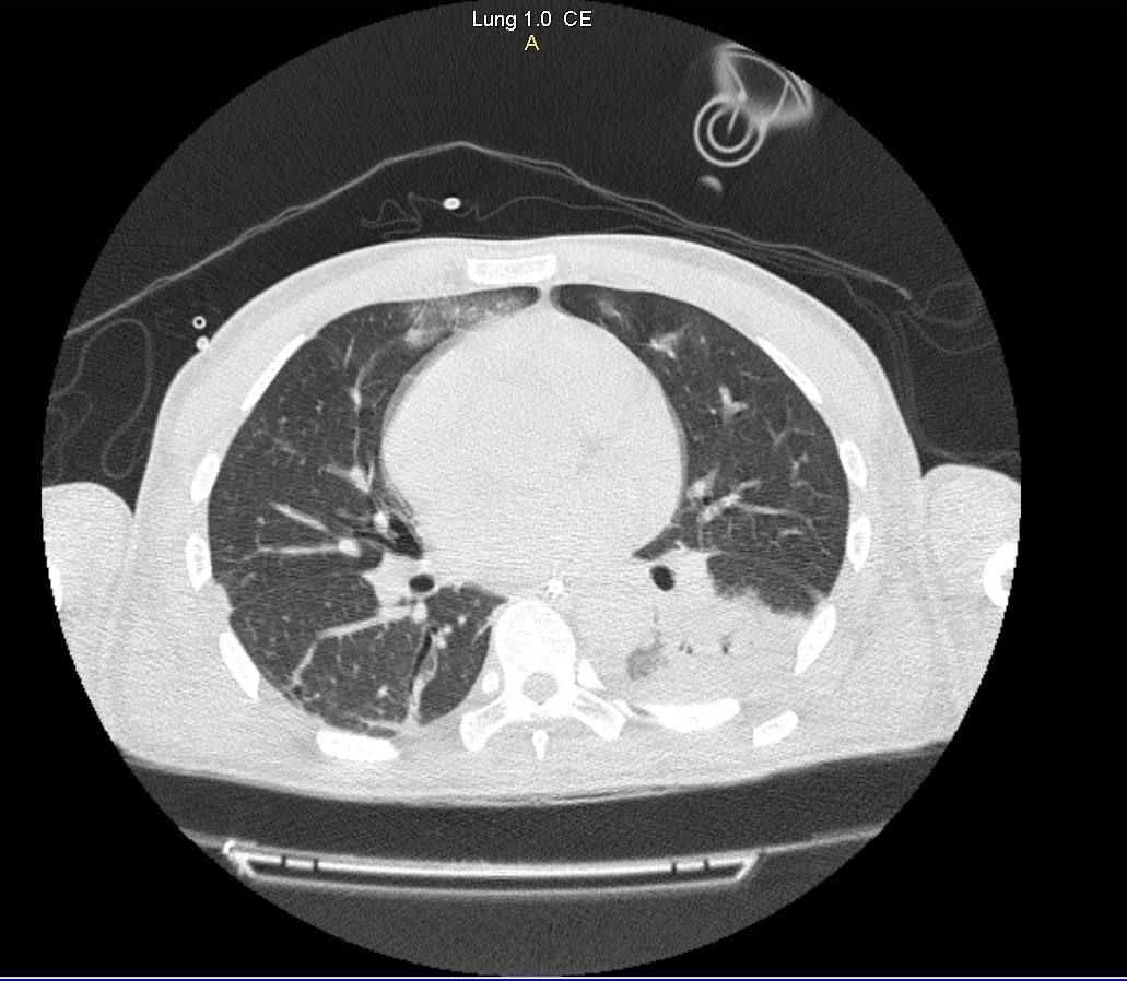 Caso clínico: um caso de infecção invasiva por Pneumococo - Portal Afya