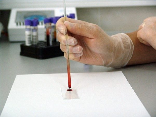 A análise laboratorial do líquido pleural - Portal Afya