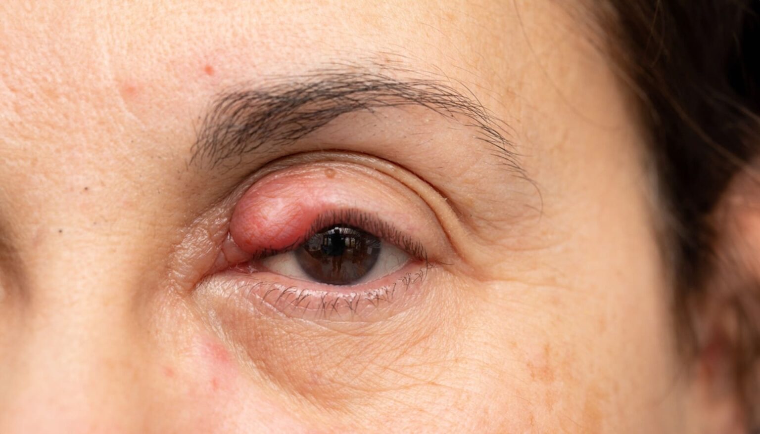 Terçol: qual é a abordagem ideal? - Portal Afya