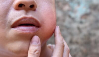 Revise seus conhecimentos sobre caxumba - Portal Afya