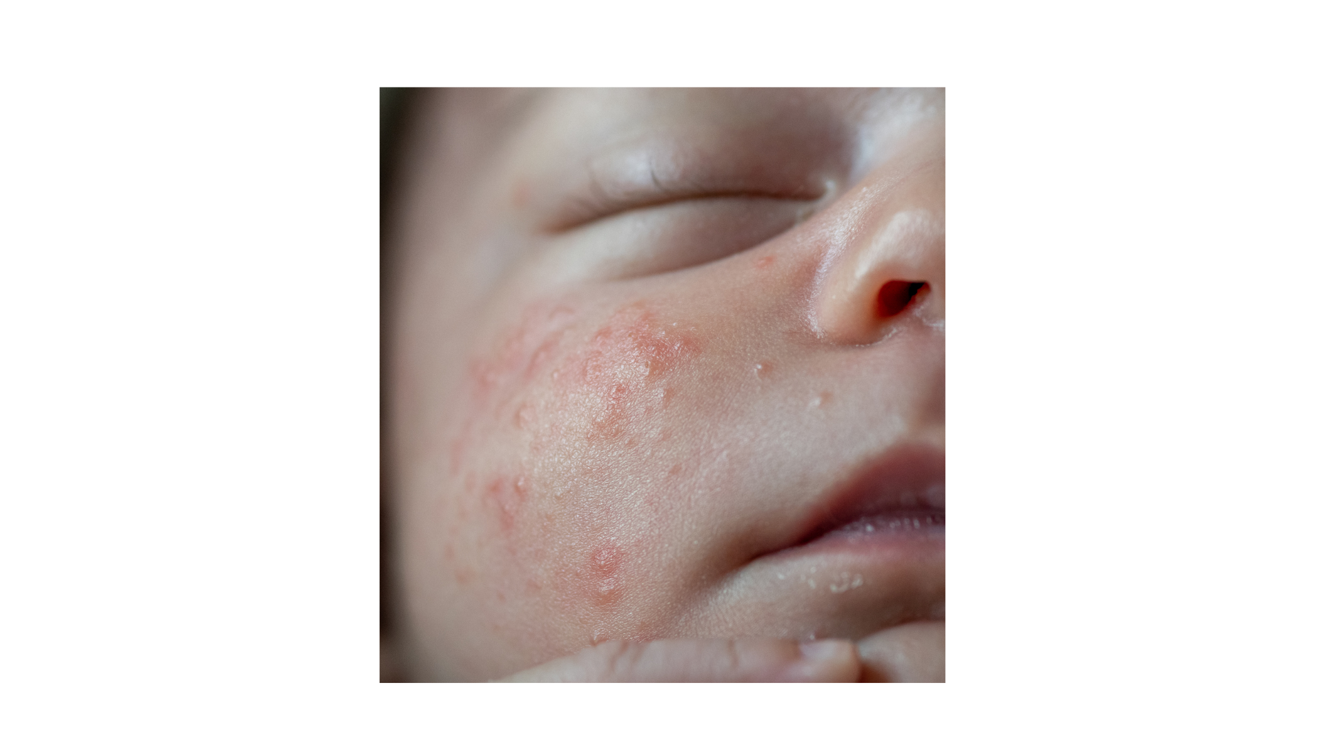 Afecções dermatológicas na infância: Doenças em neonatos - Portal Afya