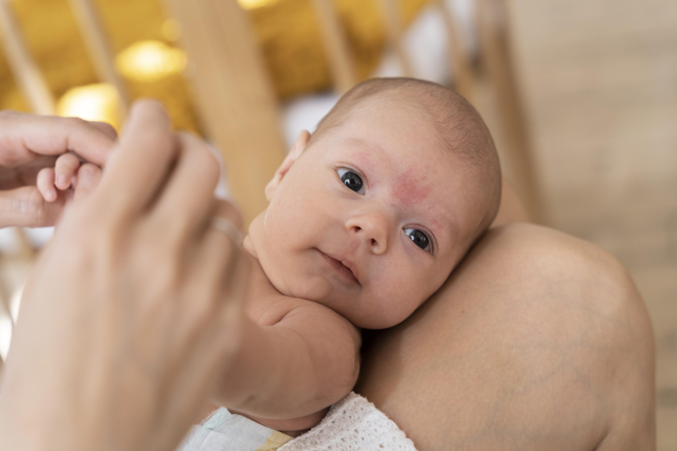 Acne neonatal - Portal Afya