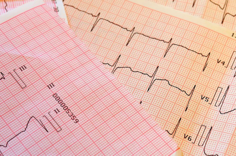 Quais os critérios de Sokolow para diagnóstico de sobrecarga de ...