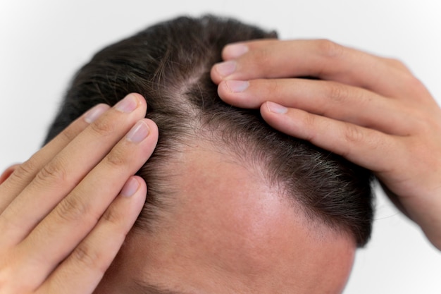 Tinea Capitis: Manifestações Clínicas E Diagnóstico - Portal Afya