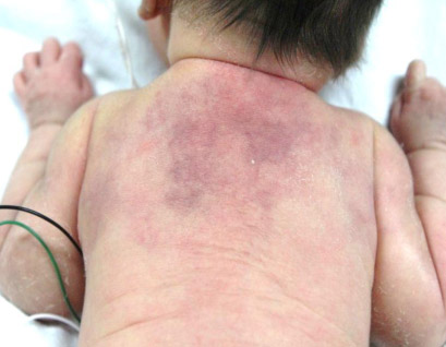 Necrose Gordurosa Subcutânea Do Recém-nascido: A Que Precisamos Ficar ...