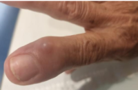 Cisto Mixoide Digital: Pode Ser Uma Consequência À Osteoartrite ...