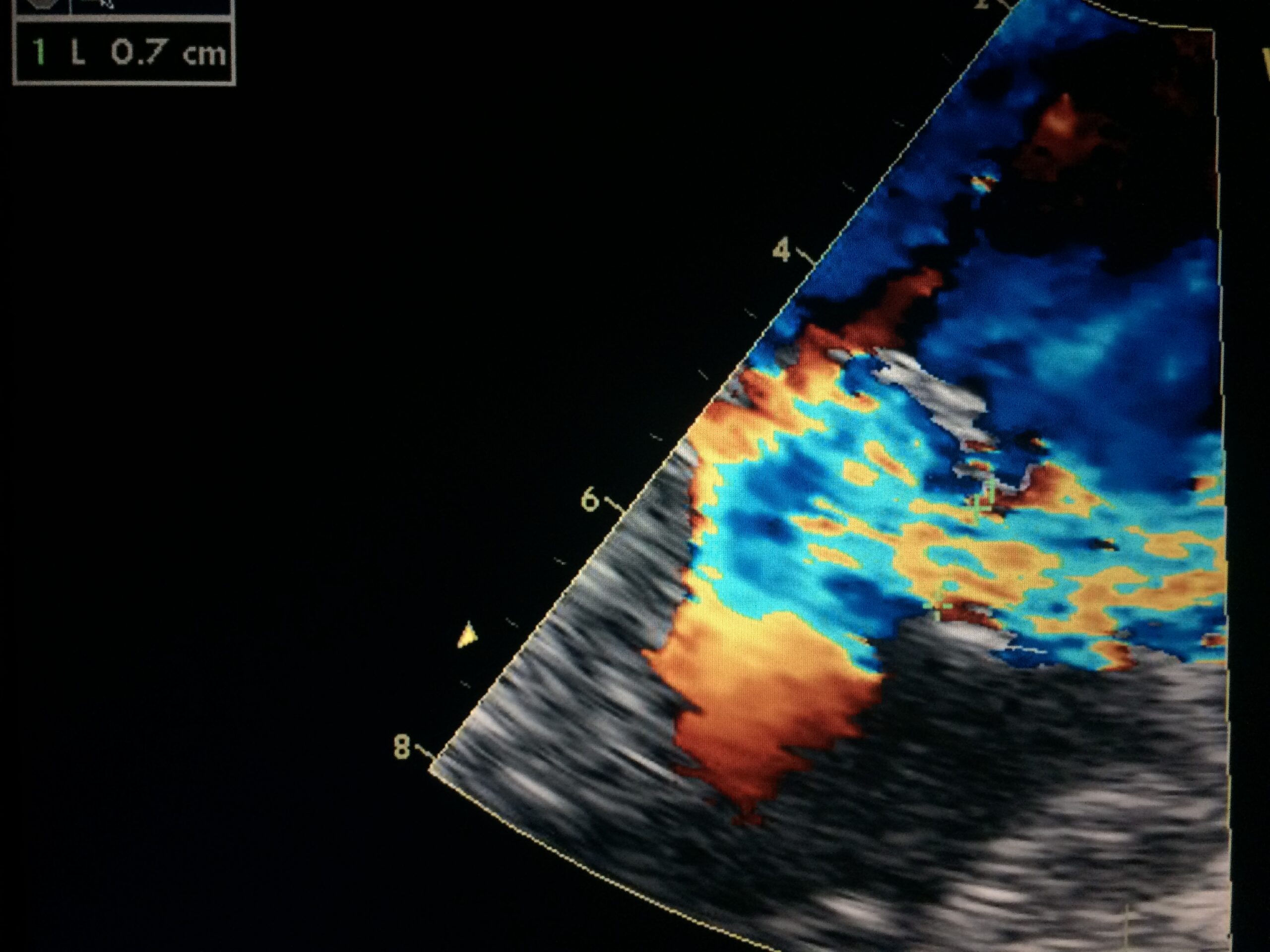 Curso básico de ecocardiograma - o que é vena contracta? - Portal Afya