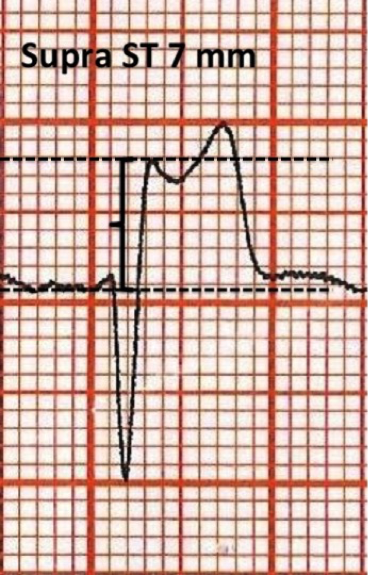 Como localizar a parede acometida por infarto com supra de ST? - Portal ...