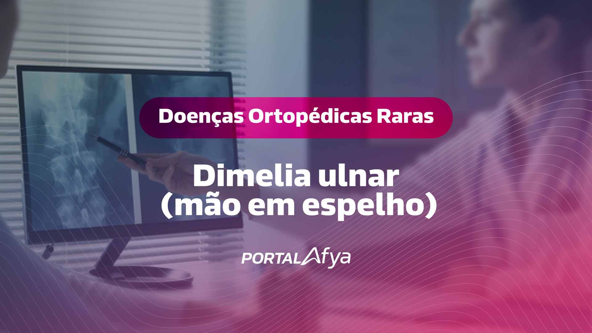 Podcast #160: Série Doenças Ortopédicas Raras: Dimelia ulnar (Mão em ...