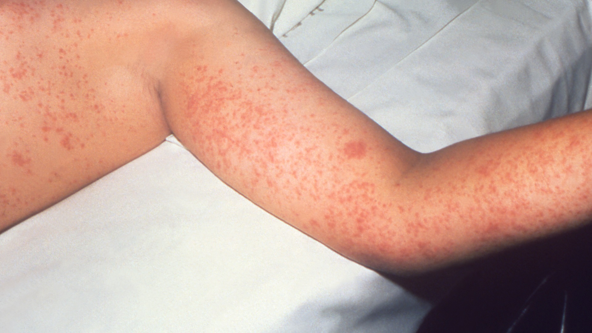 Sarampo: principais aspectos de uma doença reemergente - Portal Afya