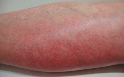 Doença de Schamberg : uma erupção purpúrica - Portal Afya