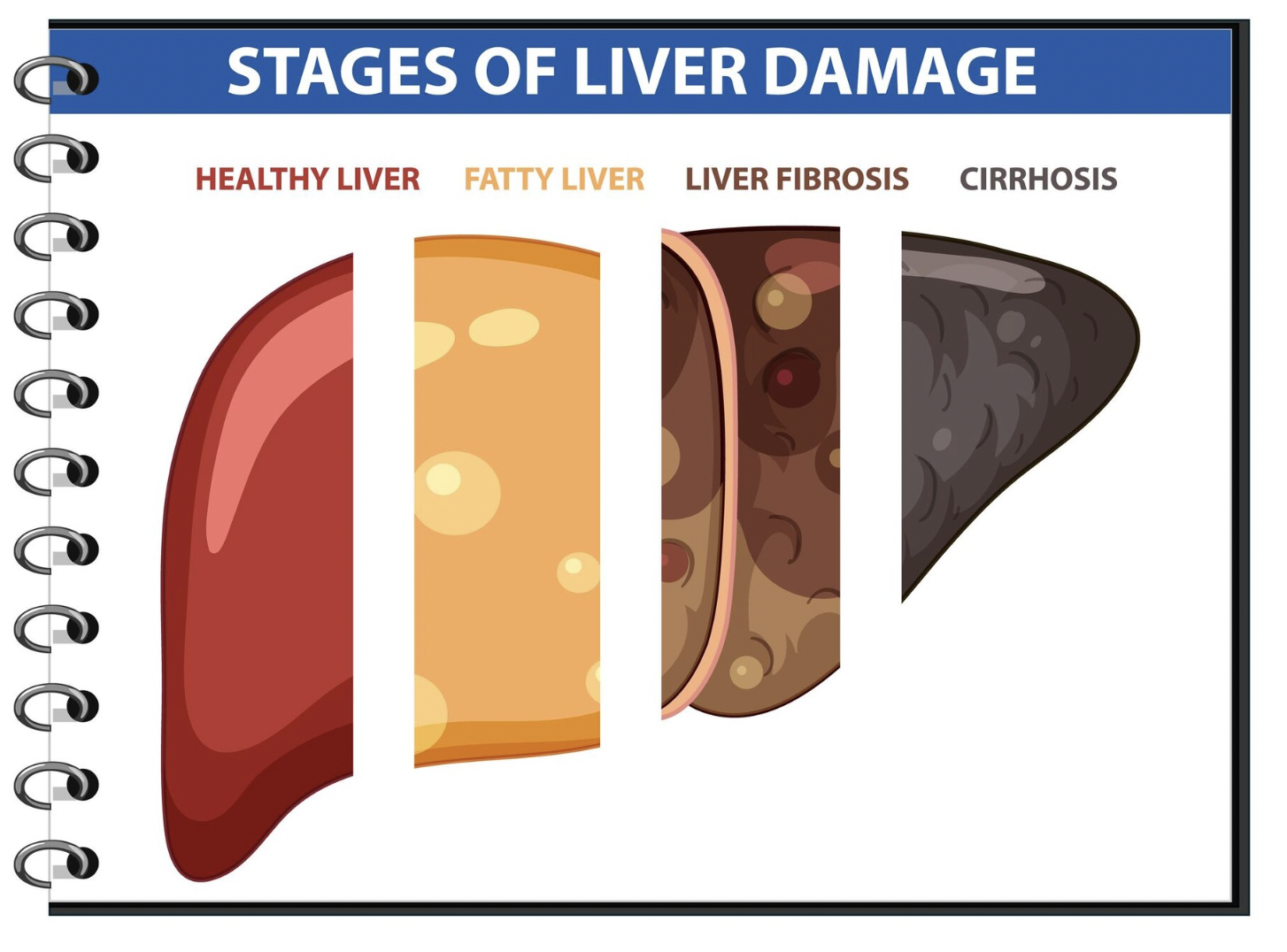 Novo consenso da ADA sobre doença hepática esteatótica no diabetes ...