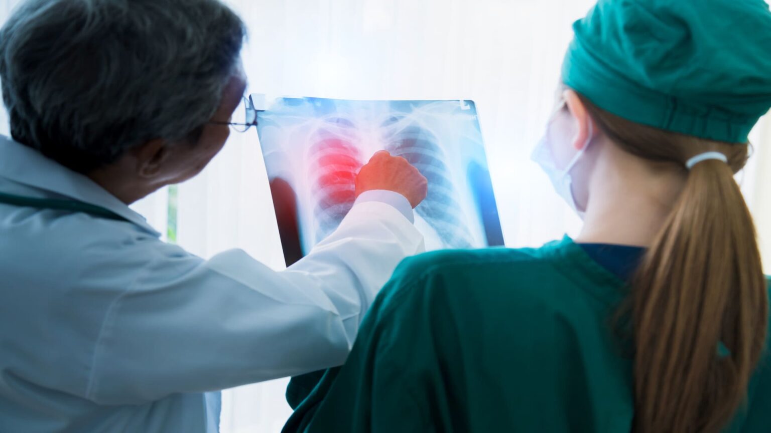 Tromboembolismo pulmonar (TEP): Veja os destaques da primeira diretriz ...